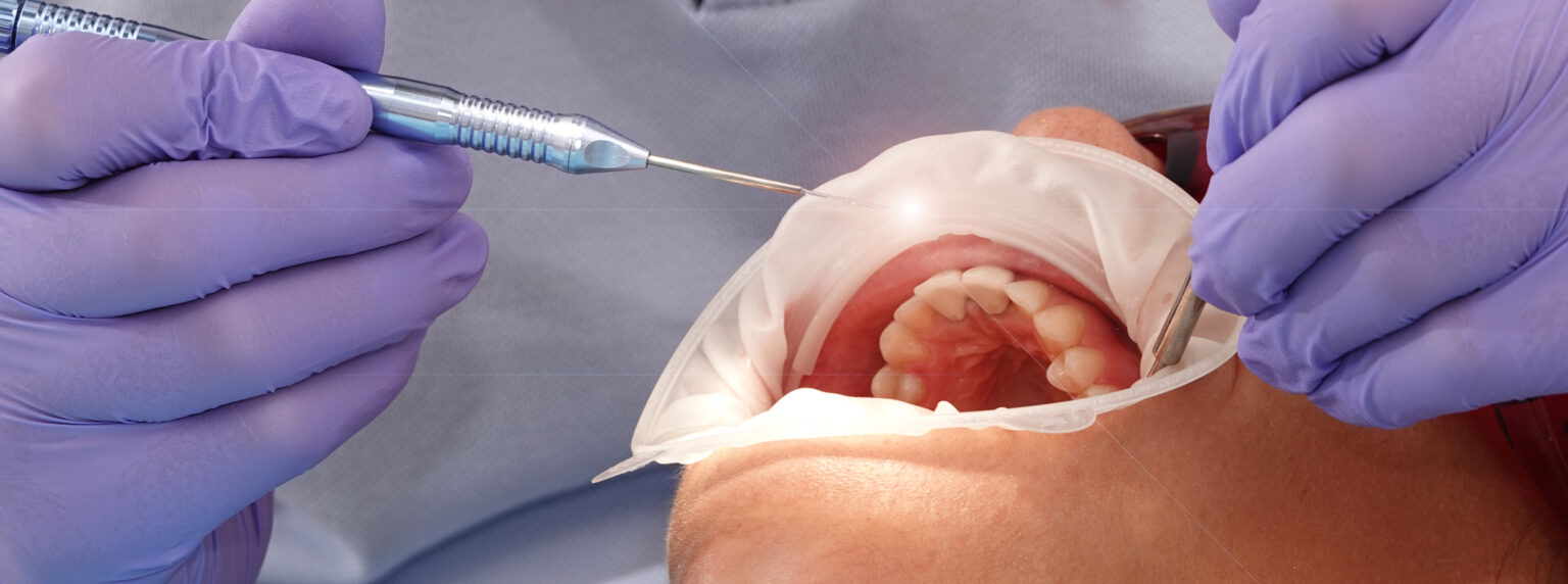 How We Treat Gum Disease Using Dental Lasers | Encinitas, CA