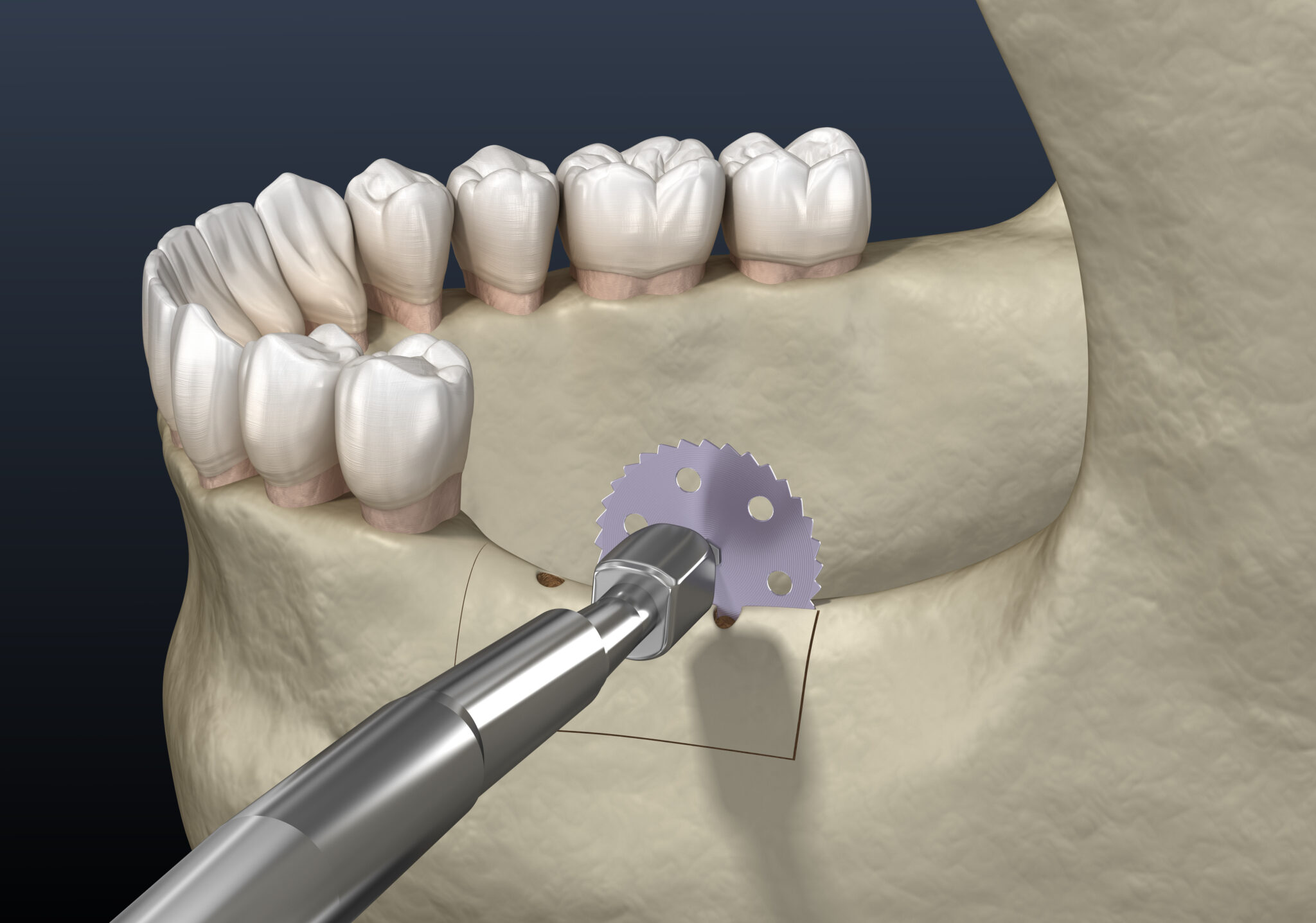 Using Lasers To Improve Grafting | Encinitas, CA