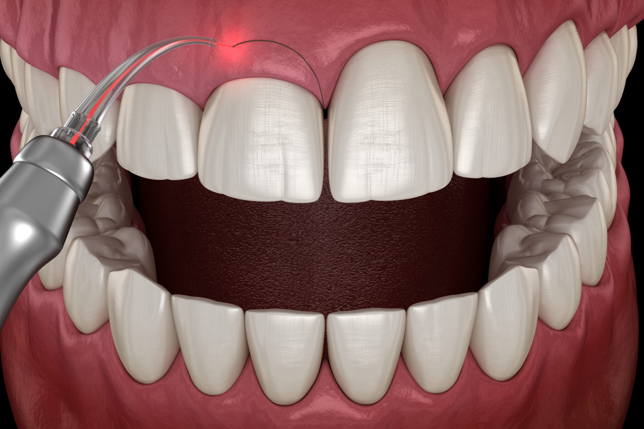 Lasers Mean Precise Periodontal Treatment | Encinitas, CA