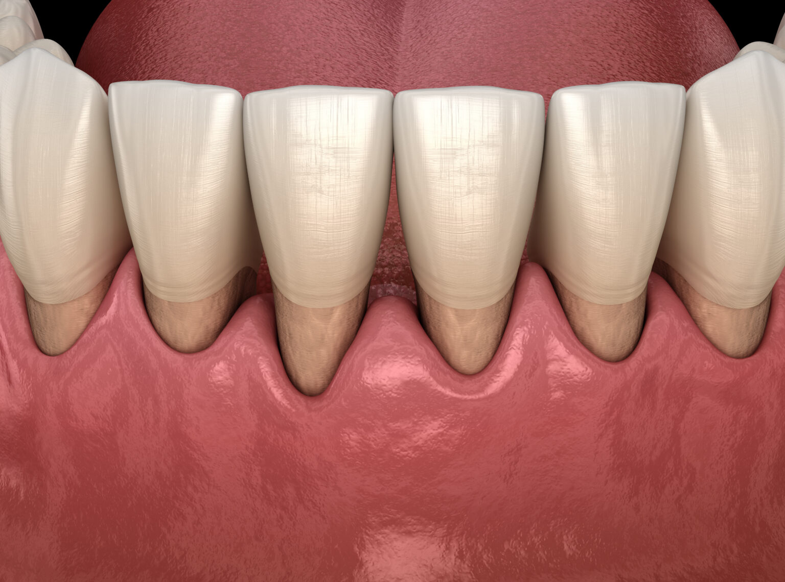 Lasers Provide Minimally Invasive Grafting | Encinitas, CA